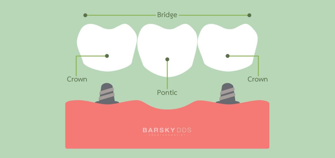 A Guide to Dental Bridge Costs & What is Included | Barsky DDS