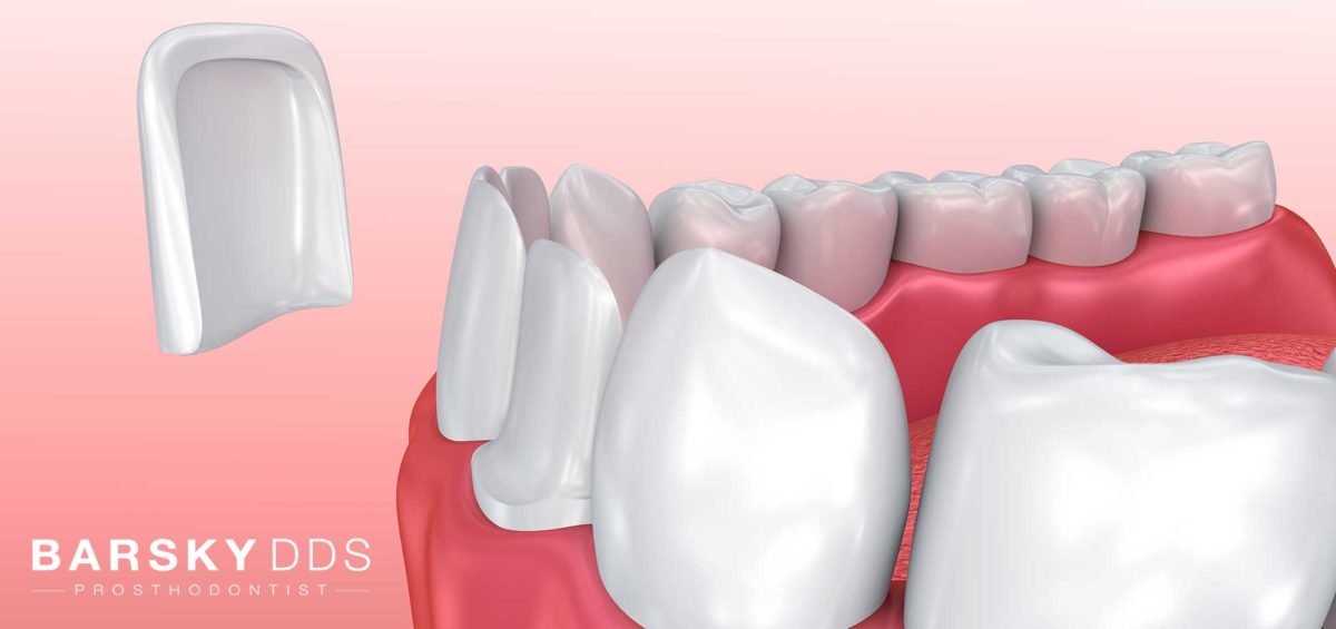 Complete Guide to Veneer Teeth in Miami with Dr. Basrky | Barsky DDS